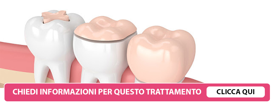 Intarsio Dentale a Lissone - Dentista Lissone - Studio Dentistico Ruzza